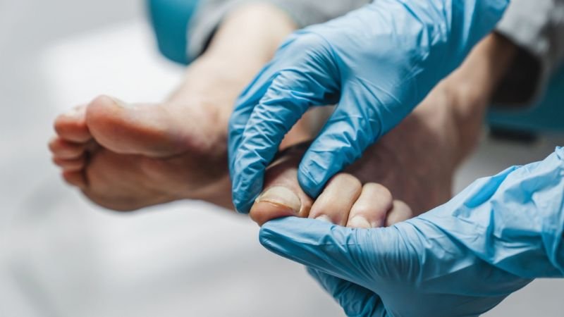 Discover the Best Remedies to Cure Your Foot Fungus